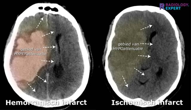 Interventieradiologie - De CVA Patient